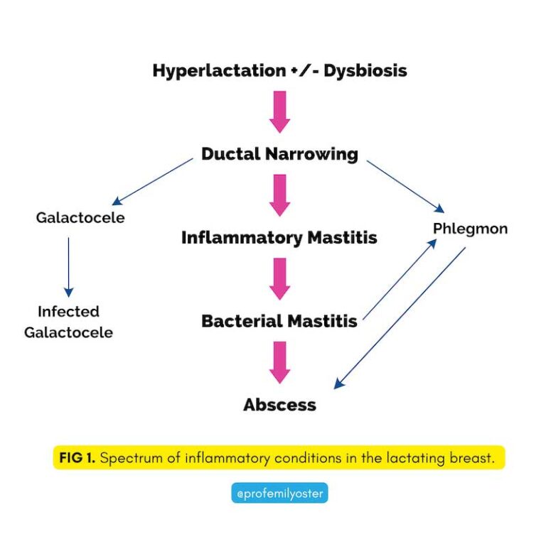 Guidance for Mastitis | ParentData by Emily Oster