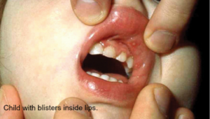 Everything You Need to Know About Hand, Foot, and Mouth | ParentData by ...